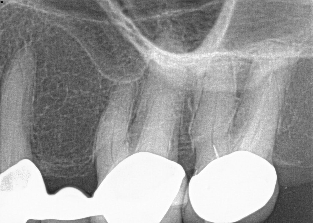 Learn from Scary Root Canal Problems - Root Canal Academy