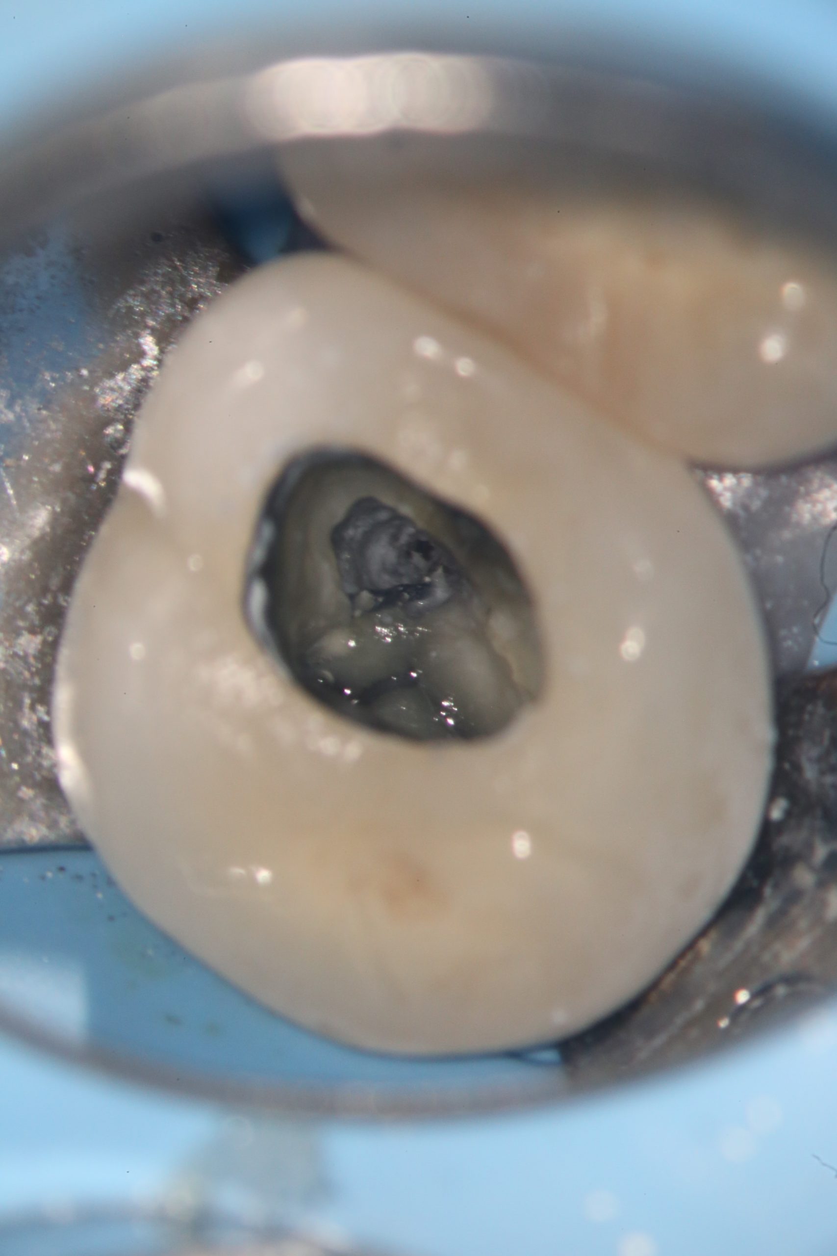 Learn from Scary Root Canal Problems - Root Canal Academy