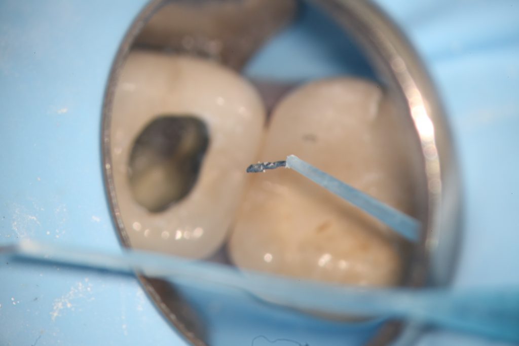 Learn from Scary Root Canal Problems - Root Canal Academy