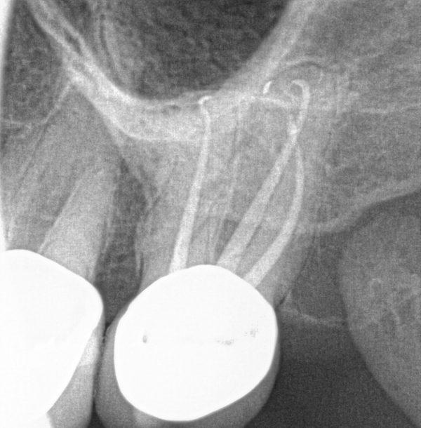 Learn from Scary Root Canal Problems - Root Canal Academy